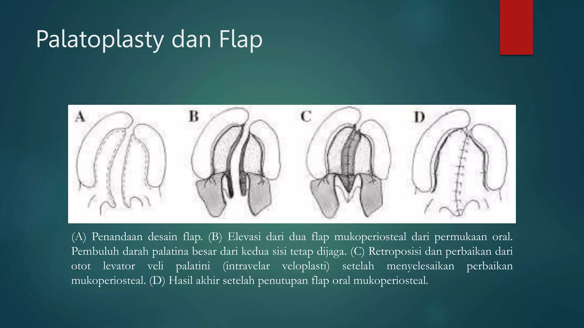 Cleft Lip & Palate.pptx