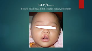 Cleft Lip & Palate.pptx