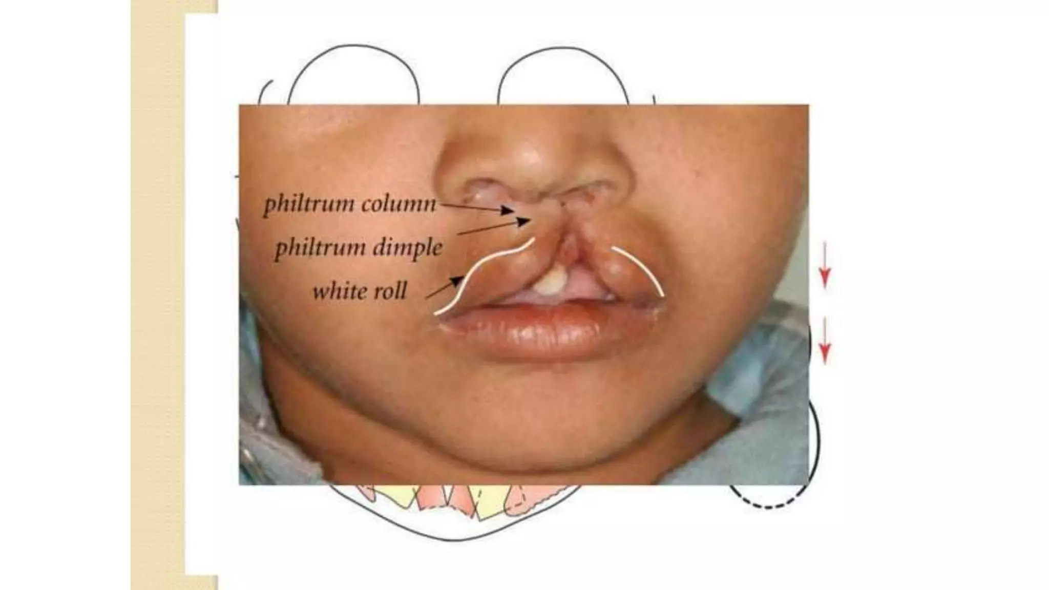 Cleft lip and Cleft Palate.pptx