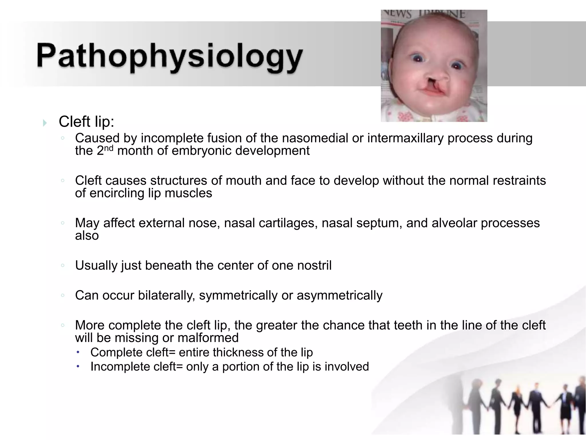 Cleft lip & palate.ppt