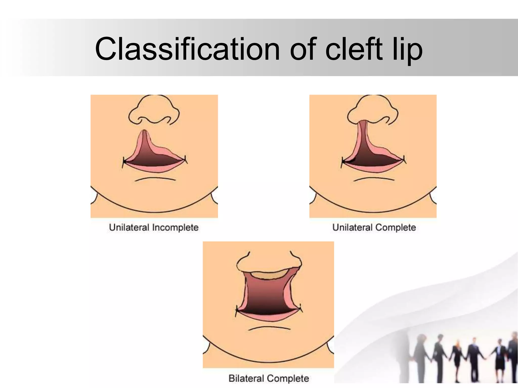 Cleft lip & palate.ppt