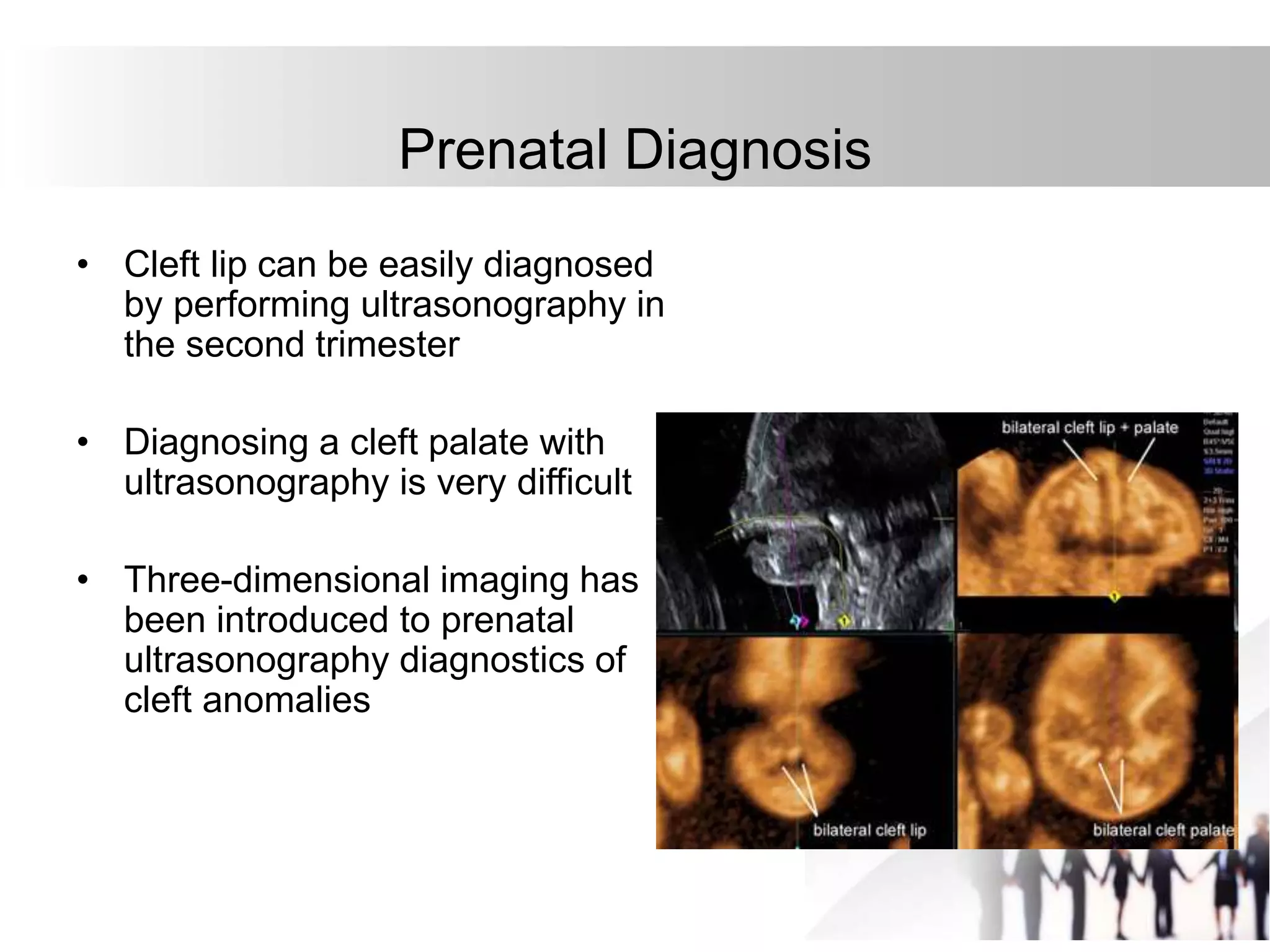 Cleft lip & palate.ppt