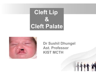 Cleft lip & palate.ppt