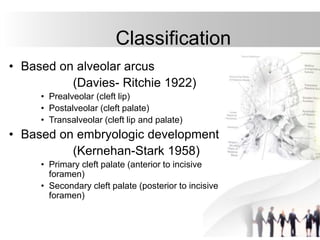 Cleft lip & palate.ppt