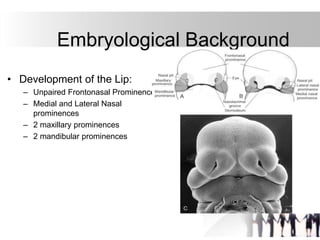Cleft lip & palate.ppt