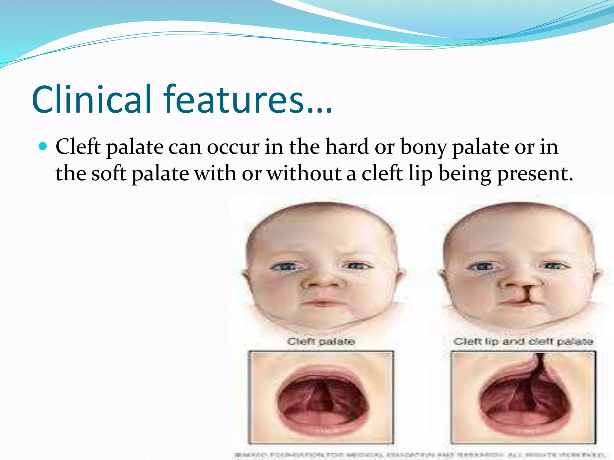 Cleft lip palate.pptx
