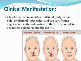 Cleft lip palate.pptx