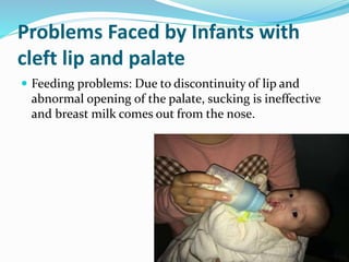 Cleft lip palate.pptx
