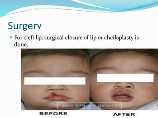 Cleft lip palate.pptx