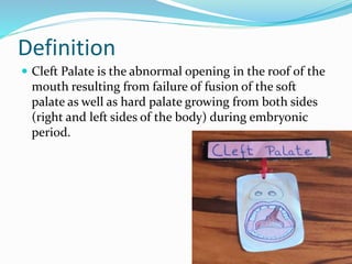 Cleft lip palate.pptx
