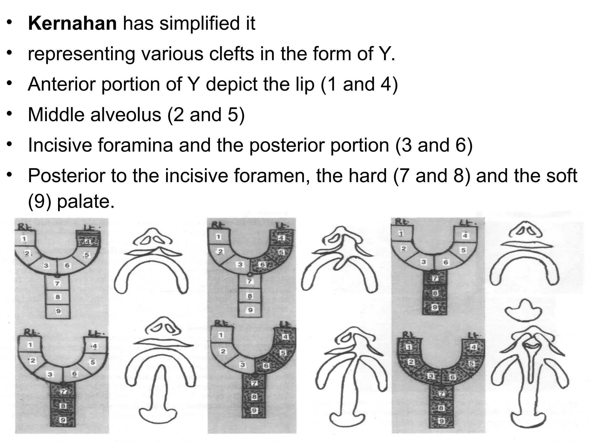 seminar on cleft lip and cleft palate.pptx
