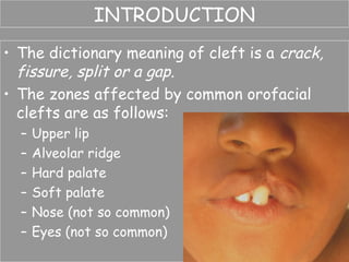 seminar on cleft lip and cleft palate.pptx