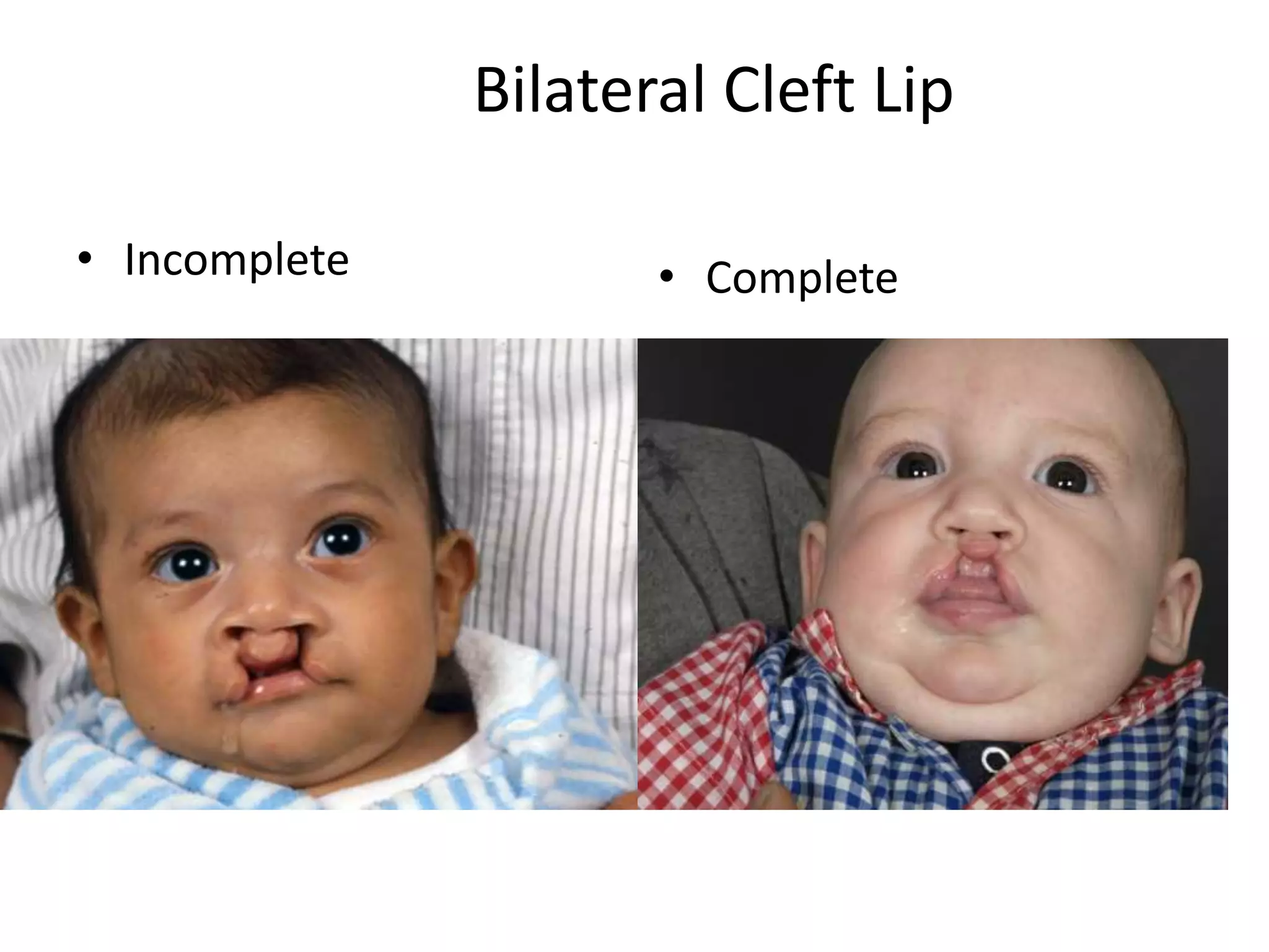 Cleft Lip & Palate KIU.pptx