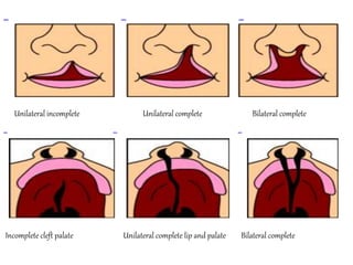 Cleft Lip & Palate KIU.pptx