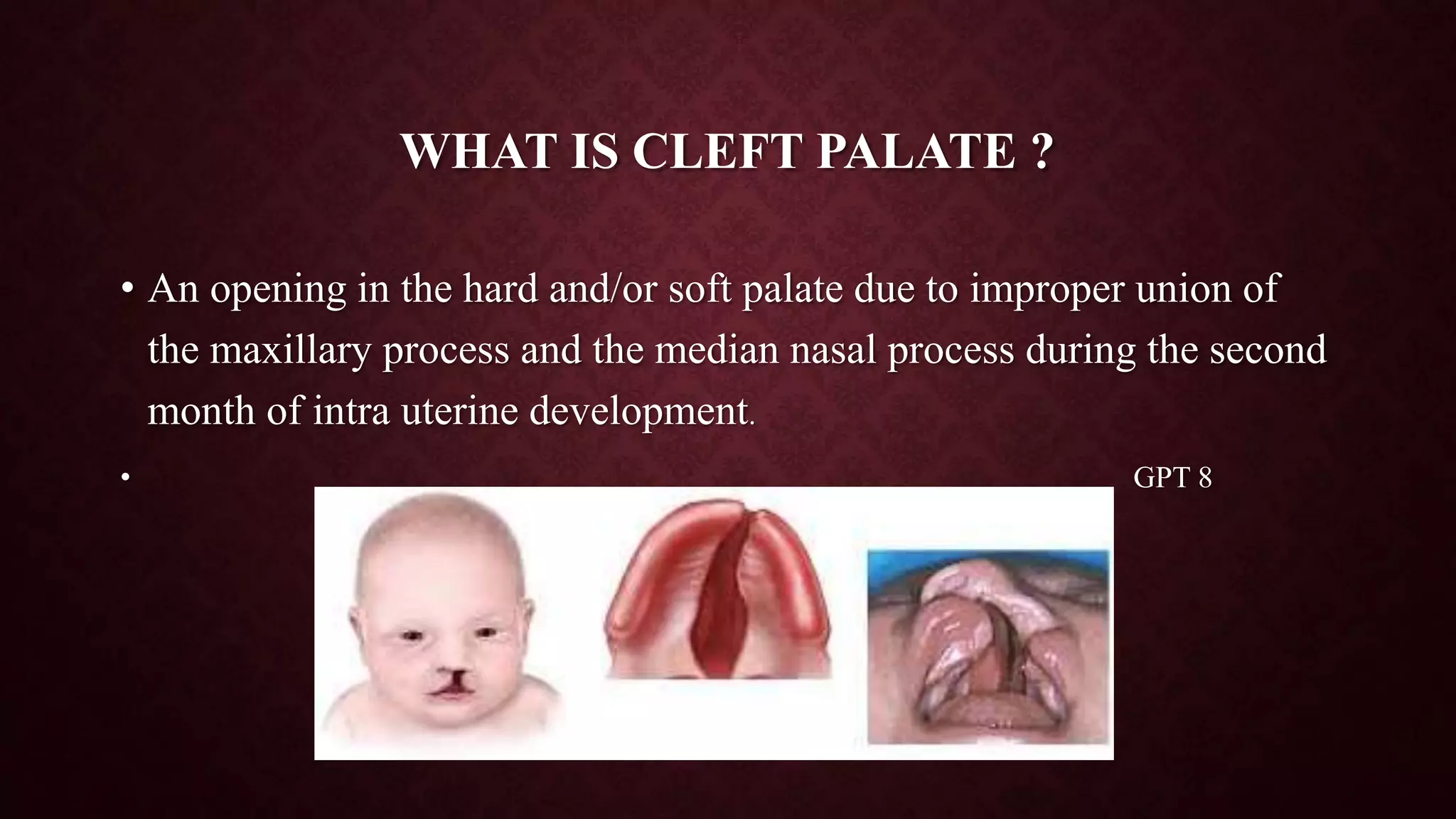 CLEFT LIP & PALATE ( SEMI 2).pptx | Ear, Nose and Throat Conditions ...