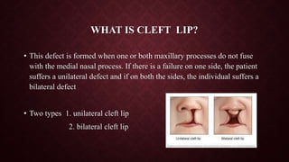 CLEFT LIP & PALATE ( SEMI 2).pptx