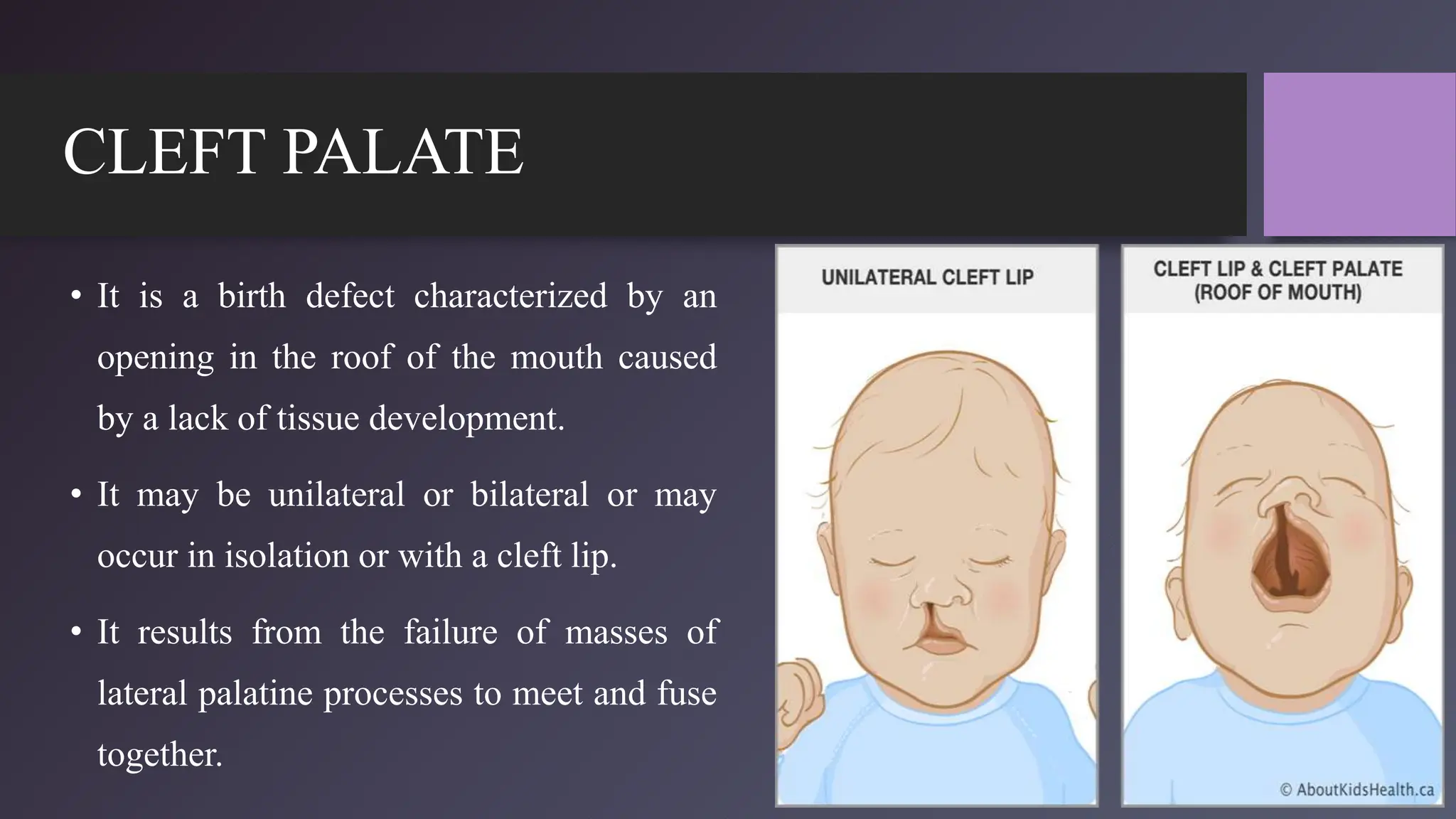 Presentation on Cleft Lip and Cleft Palate | PPTX