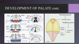 Presentation on Cleft Lip and Cleft Palate | PPTX