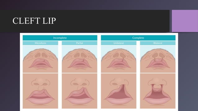 Presentation on Cleft Lip and Cleft Palate | PPTX | Pregnancy | Reproductive Health