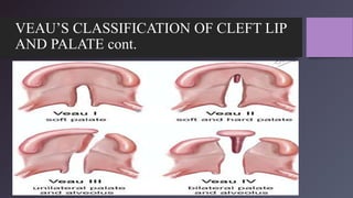 Presentation on Cleft Lip and Cleft Palate | PPTX