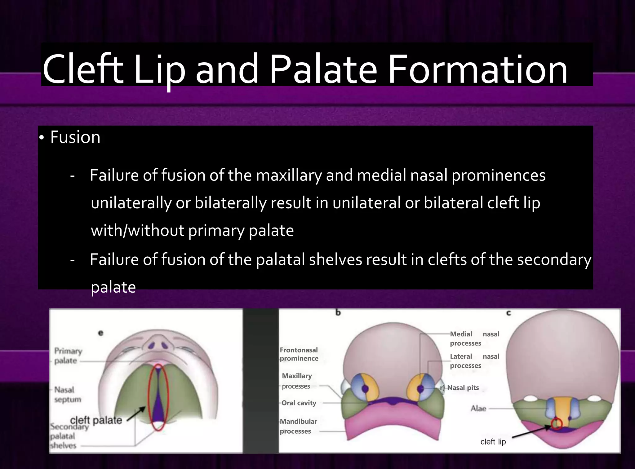 Cleft lip repair | PPTX