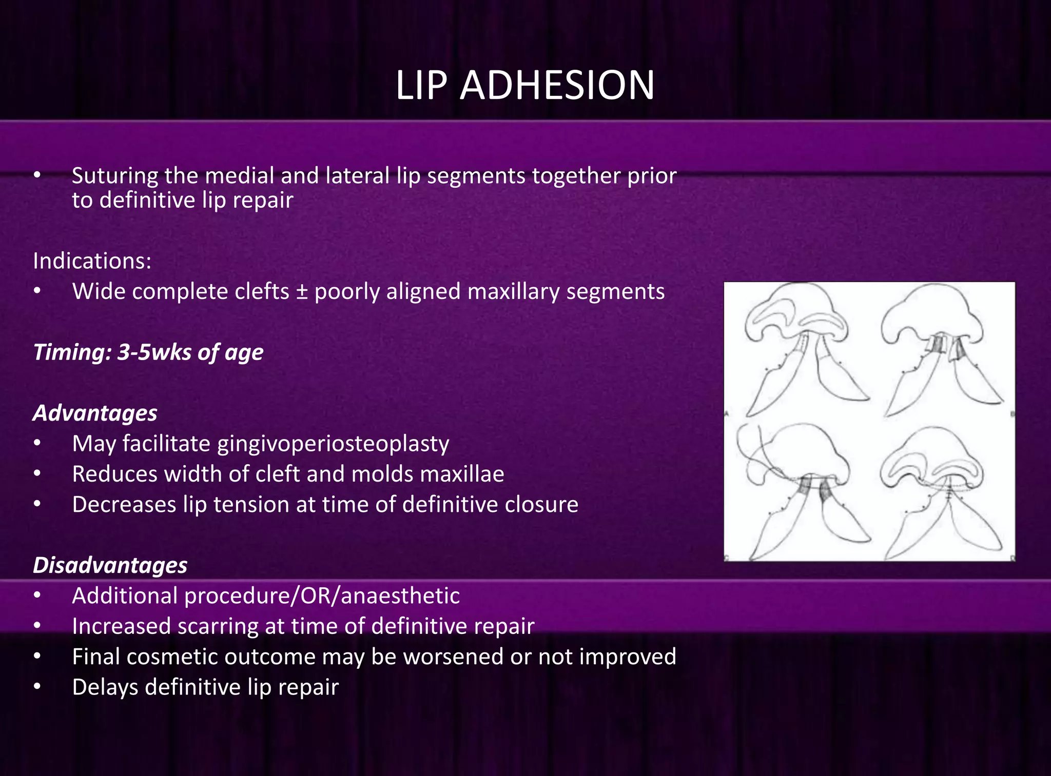 Cleft lip repair | PPTX
