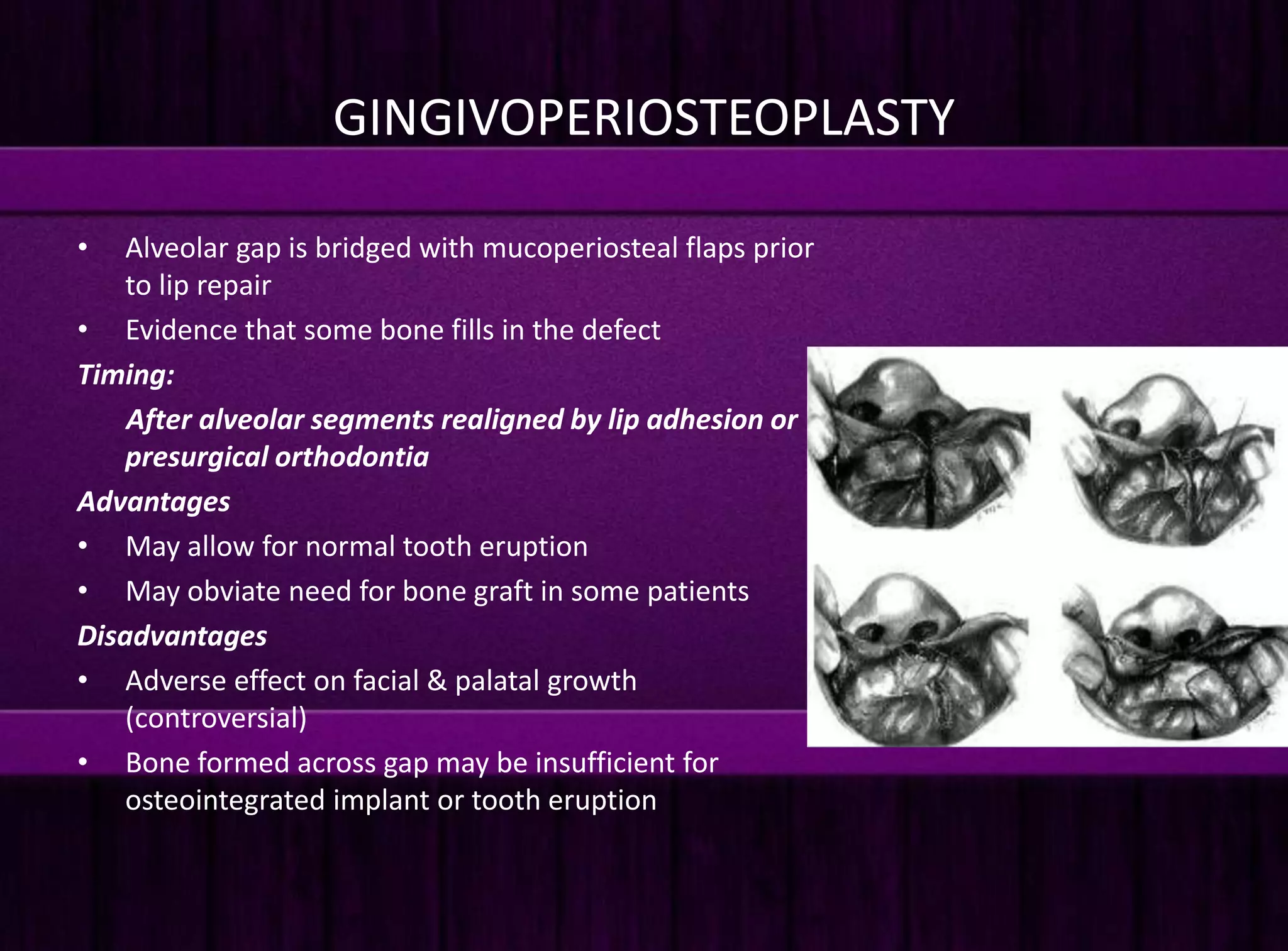 Cleft lip repair | PPTX