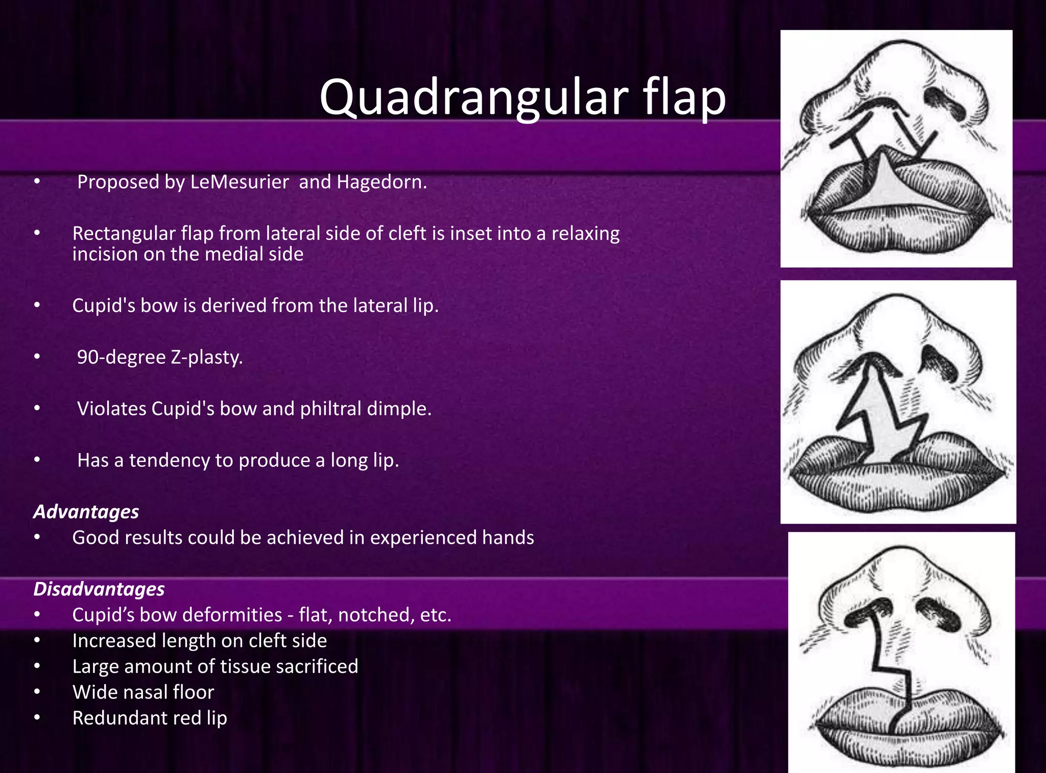 Cleft lip repair | PPTX
