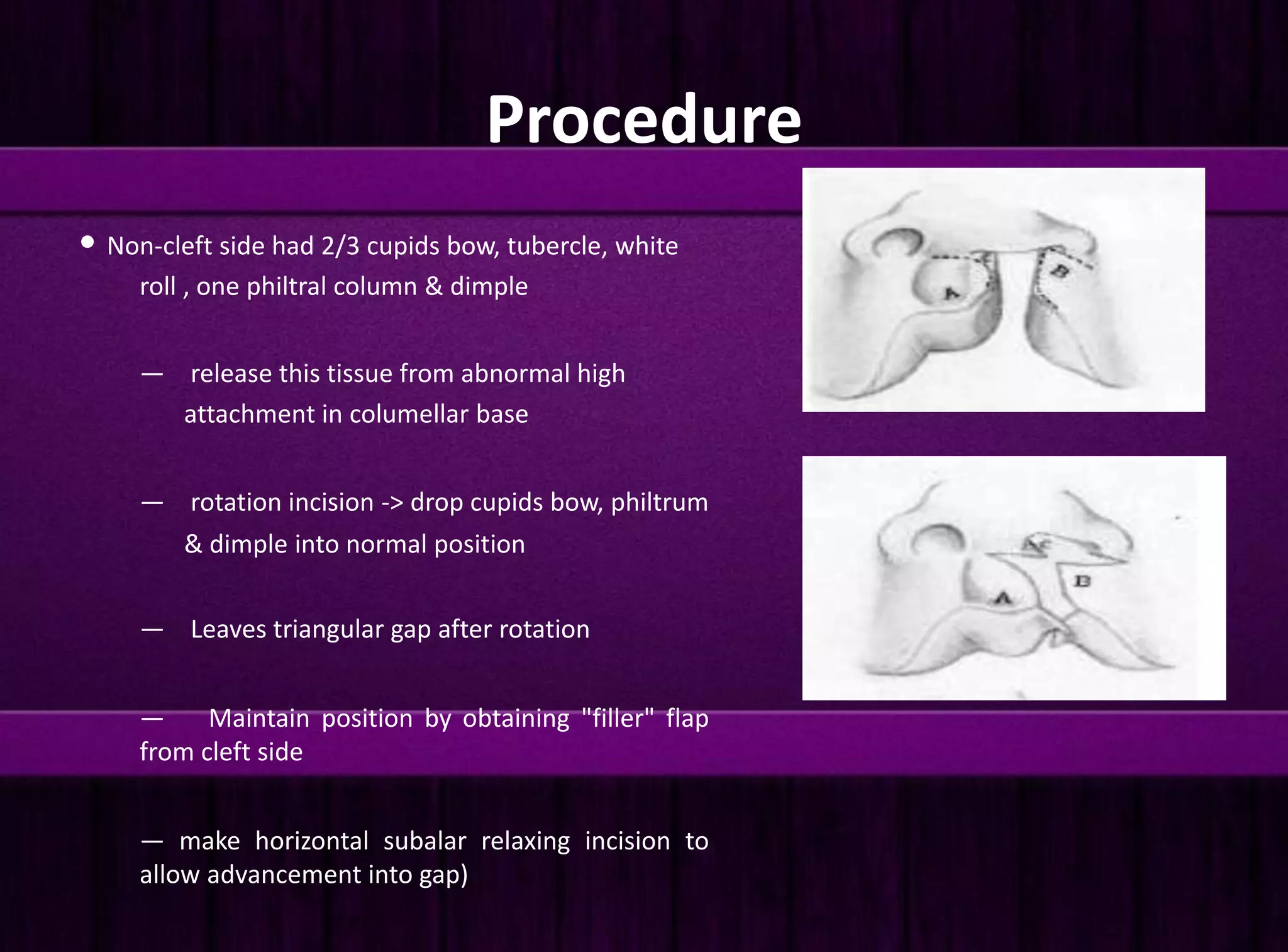 Cleft lip repair | PPTX