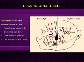 Tessier Cleft Diagram