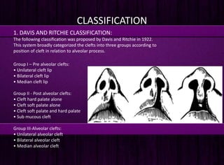 Cleft lip repair | PPT