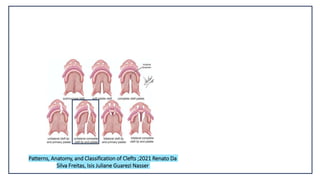 CASE PRESENTATION ON CLEFT LIP Mazhil.pptx