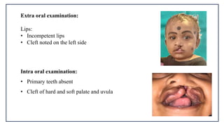 CASE PRESENTATION ON CLEFT LIP Mazhil.pptx