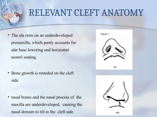 CLEFT NOSE CLEFT NOSE RHINOPLASTY v.pptx | Ear, Nose and Throat ...
