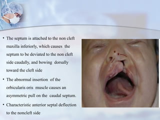 CLEFT NOSE CLEFT NOSE RHINOPLASTY v.pptx | Ear, Nose and Throat ...