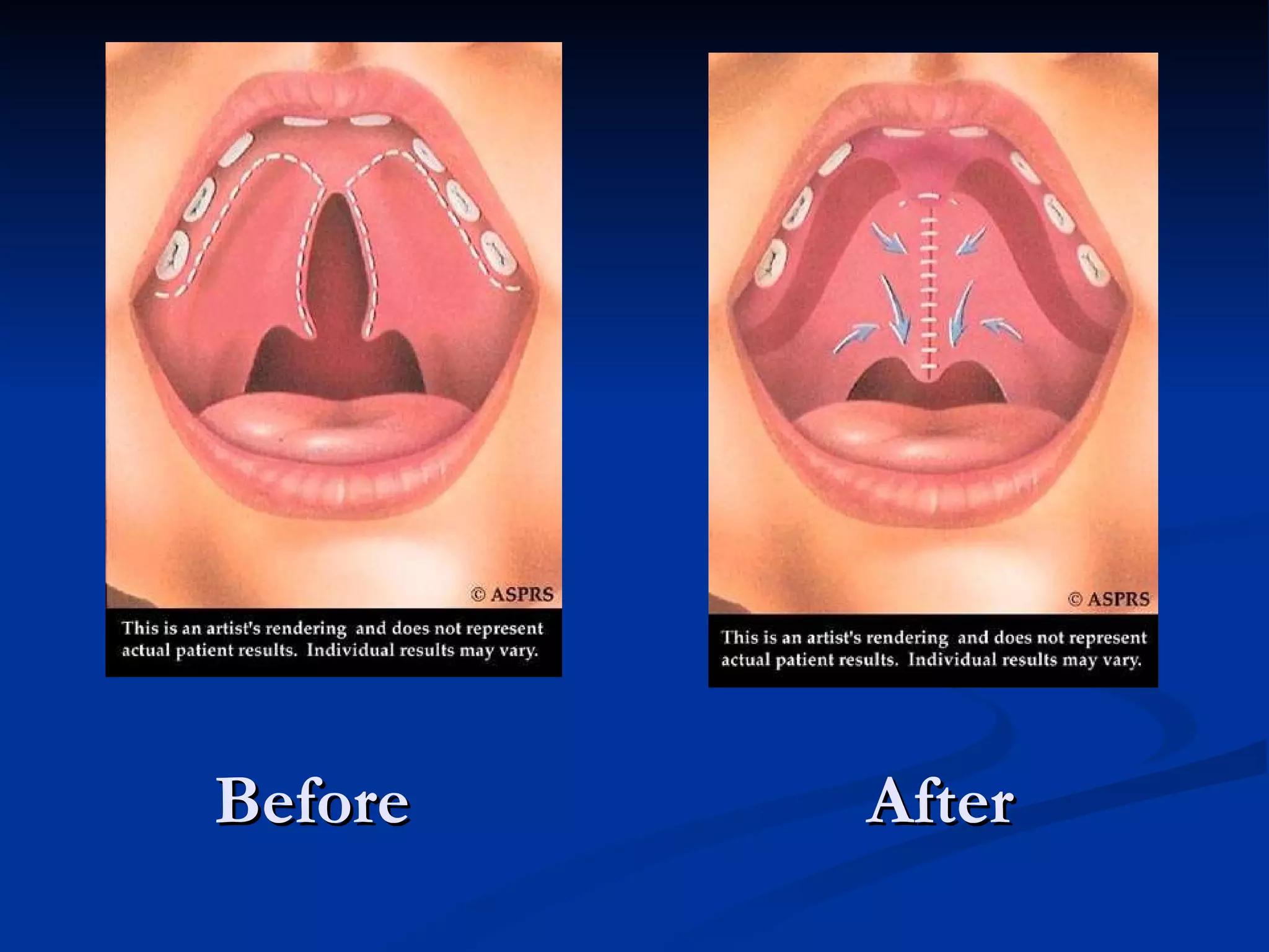 Cleft palate | PPT