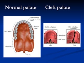 Cleft Palate Anatomy