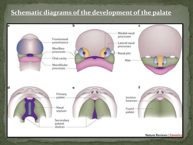 Cleft palate dental oral pathology | PPTX | Dental Health | Diseases ...