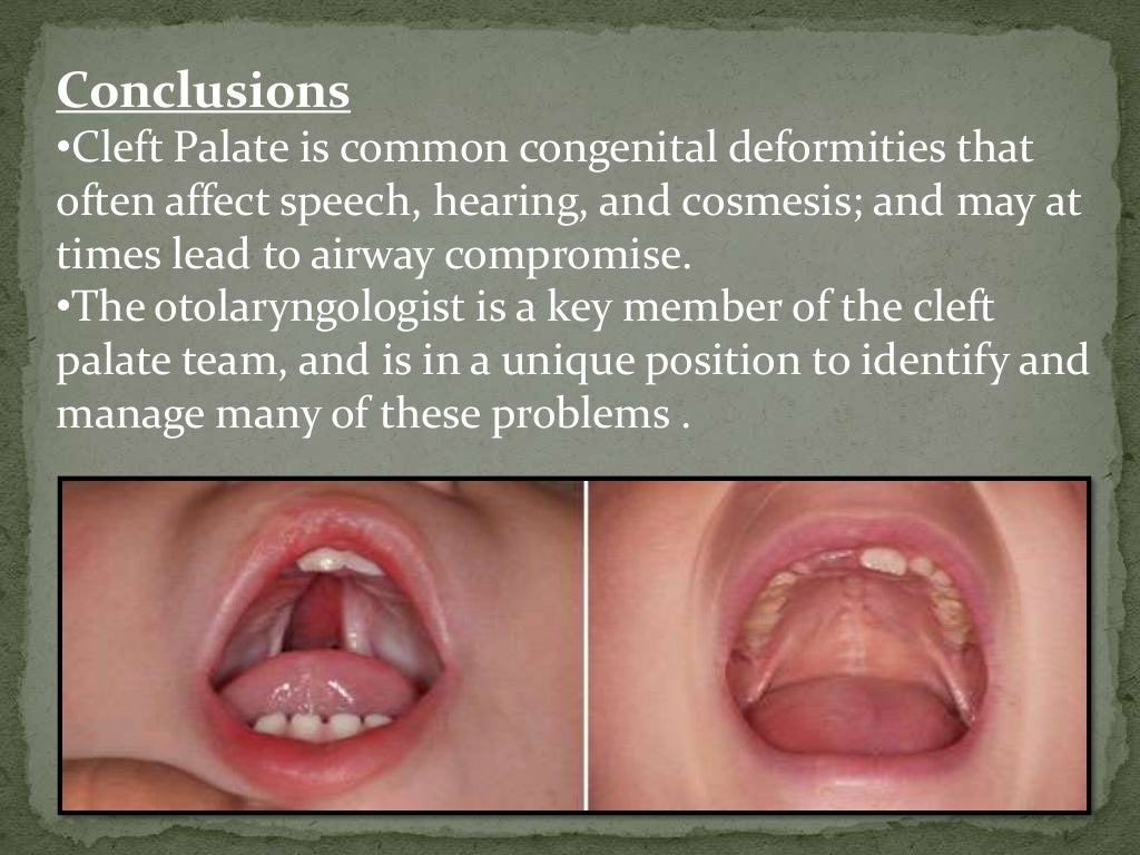 Cleft palate dental oral pathology