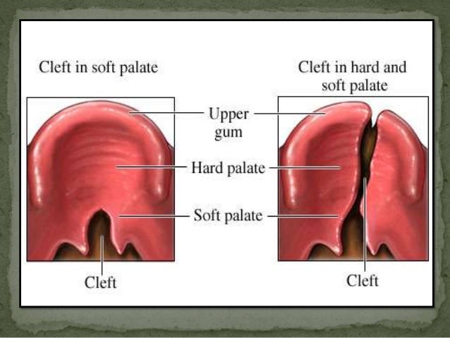 Cleft palate dental oral pathology