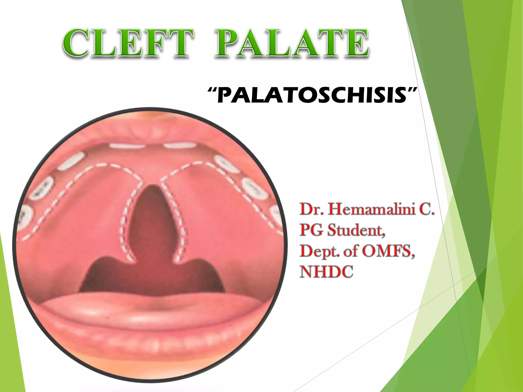 Surgical treatments in Cleft palate | PPT