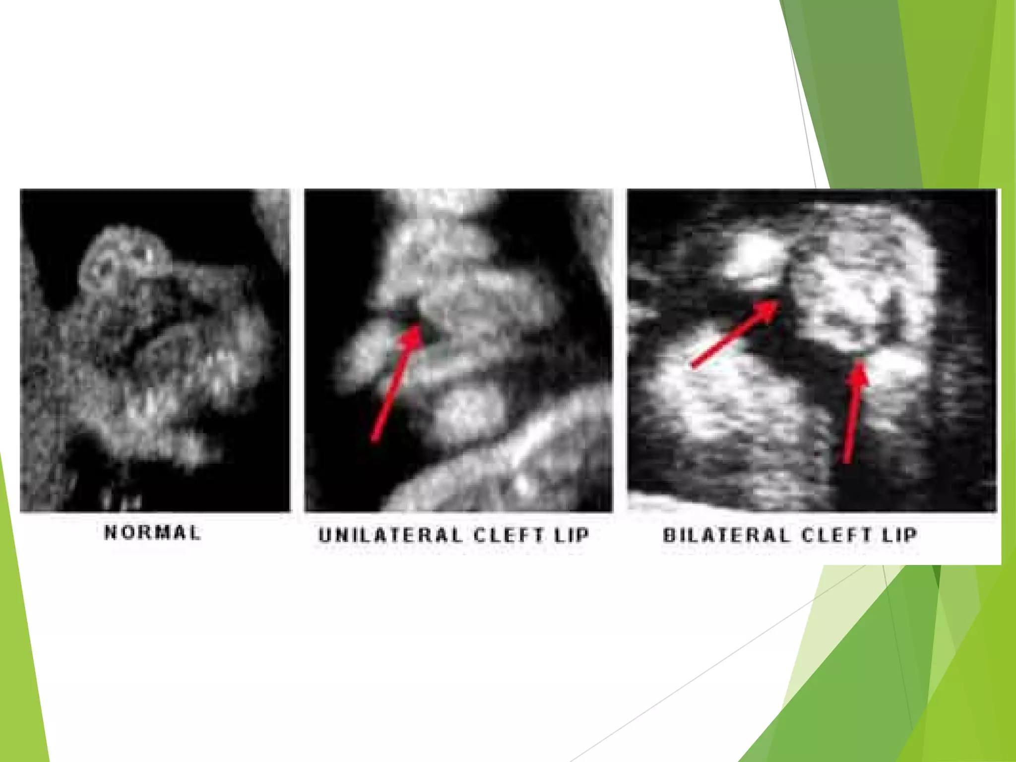 Surgical treatments in Cleft palate | PPT