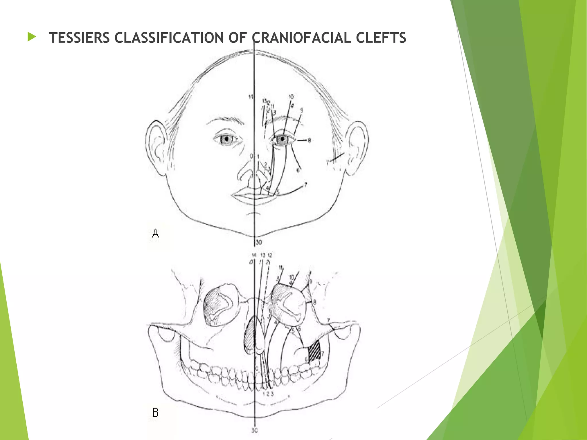 Surgical treatments in Cleft palate | PPT