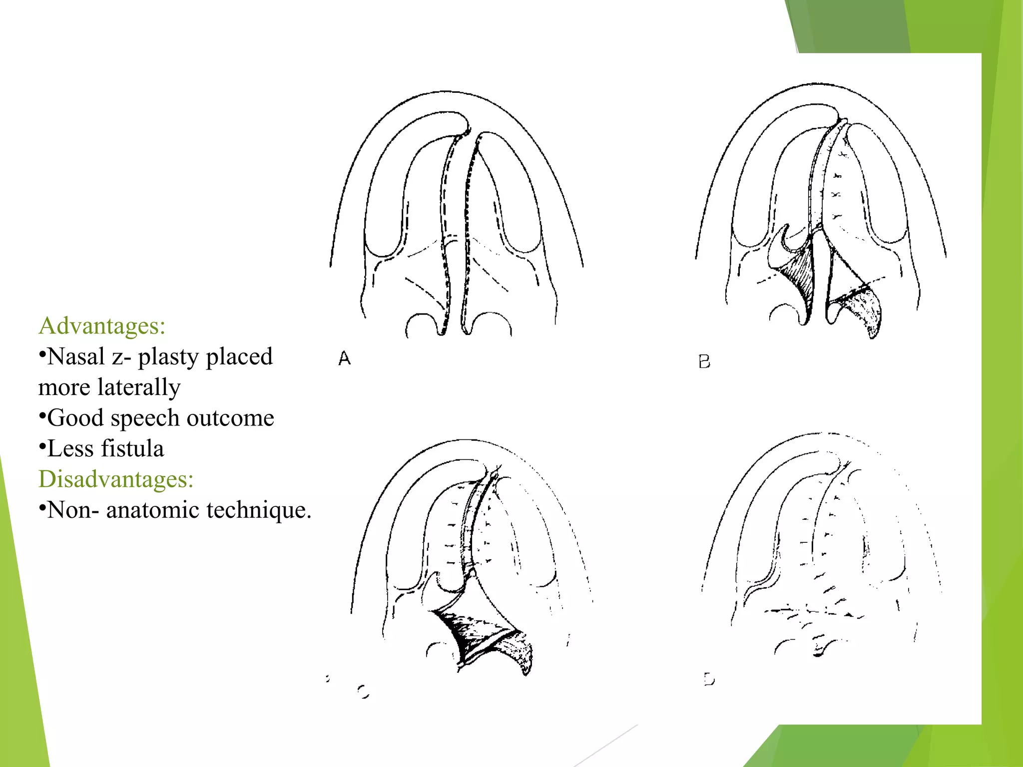 Surgical treatments in Cleft palate | PPT