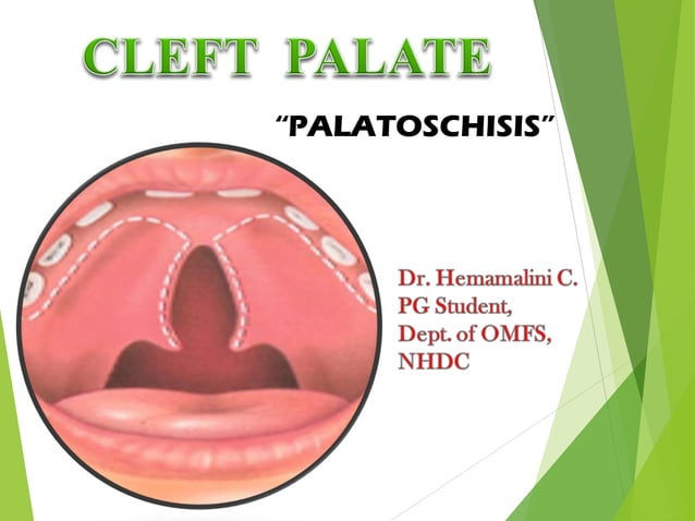 Surgical treatments in Cleft palate | PPT