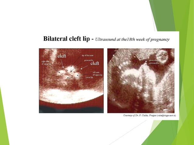 Surgical treatments in Cleft palate | PPT