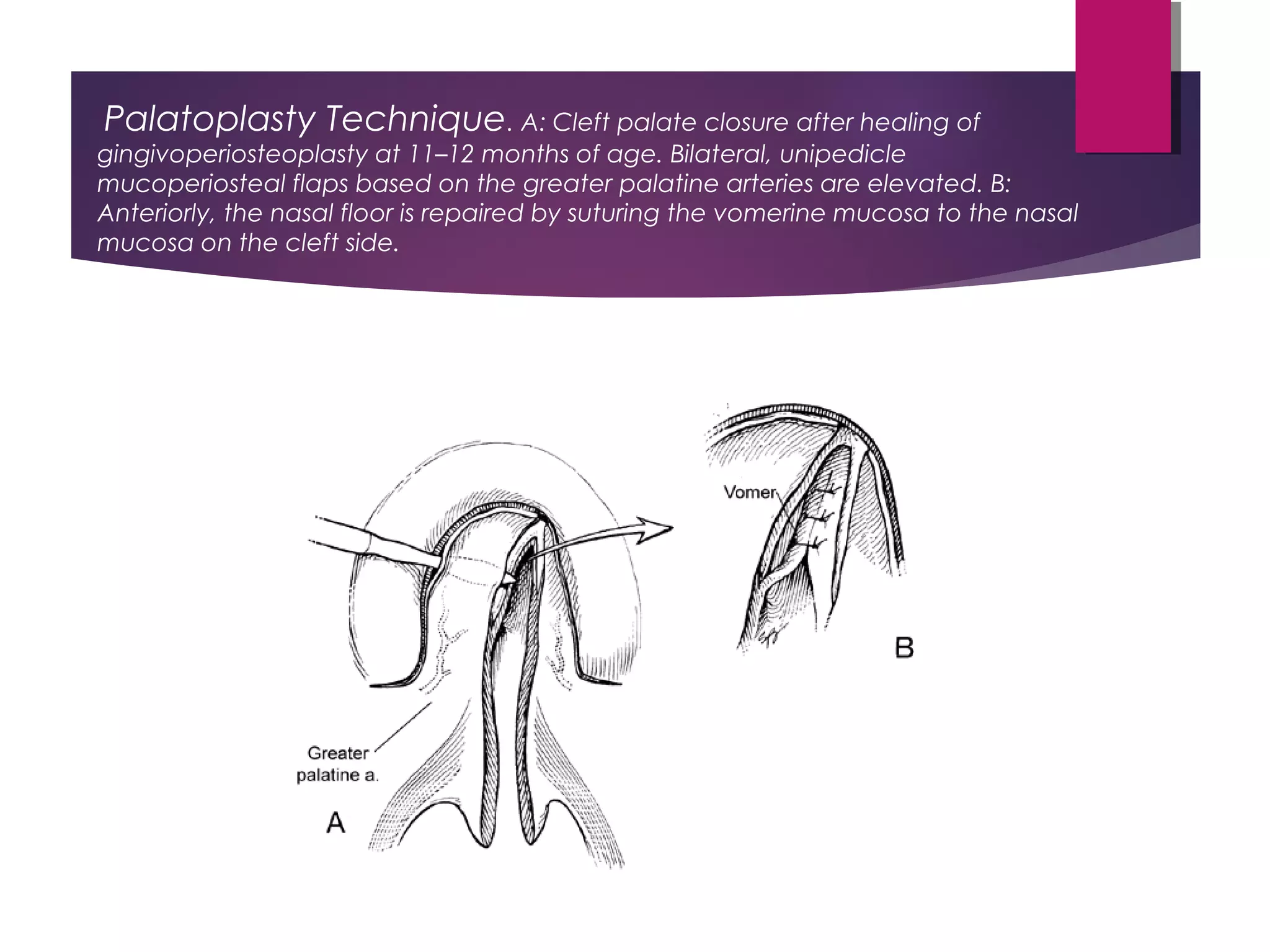 Cleft palate Lecture notes ppt | PPT