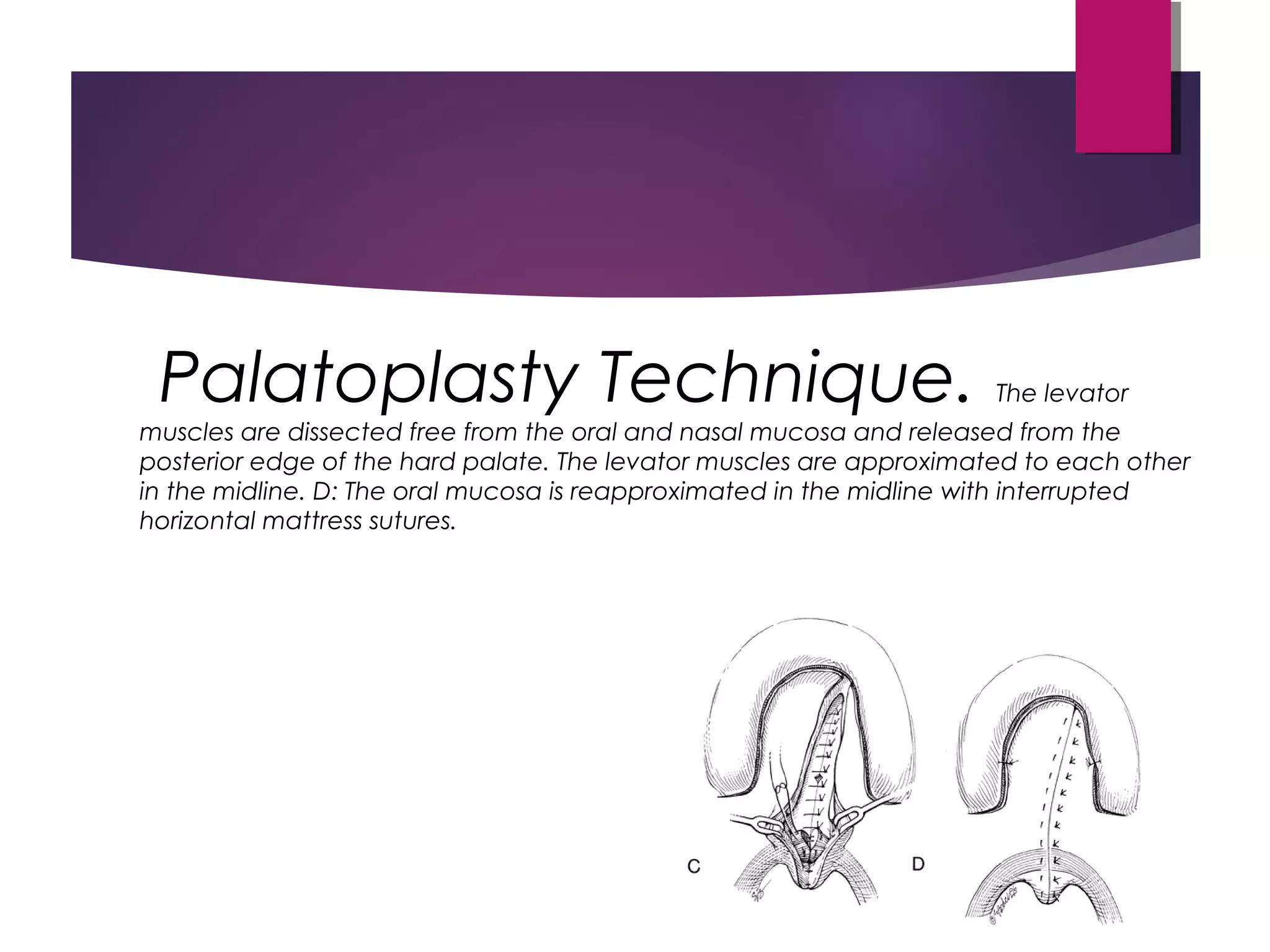 Cleft palate Lecture notes ppt | PPT