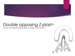 Cleft palate Lecture notes ppt | PPT