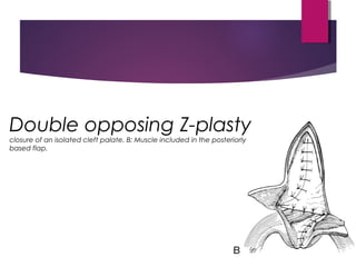 Cleft palate Lecture notes ppt | PPT